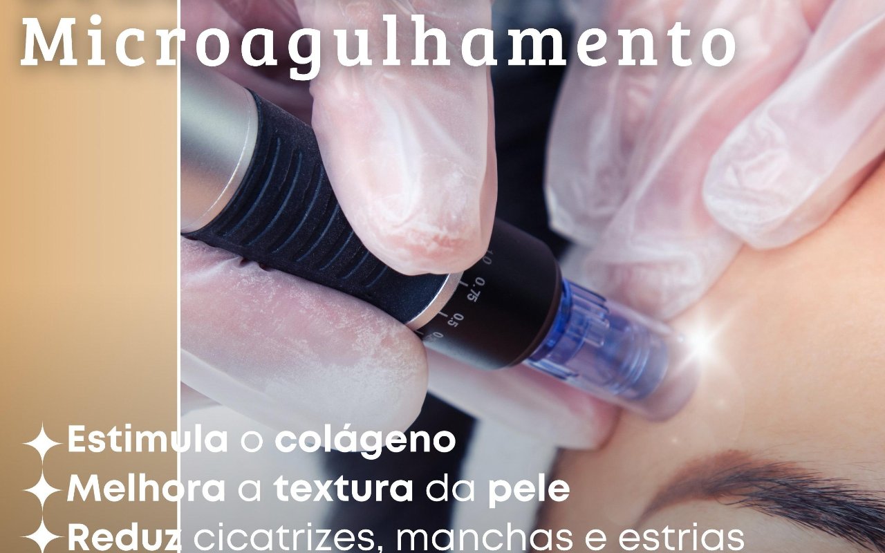 Microagulhamento Corporal perto Estrela, Lisboa - Treatwell